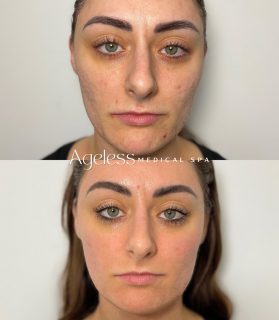 BBL Laser - Ageless Medical Spa