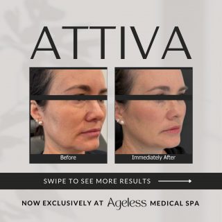 Attiva Before and After Gallery - Ageless Medical Spa