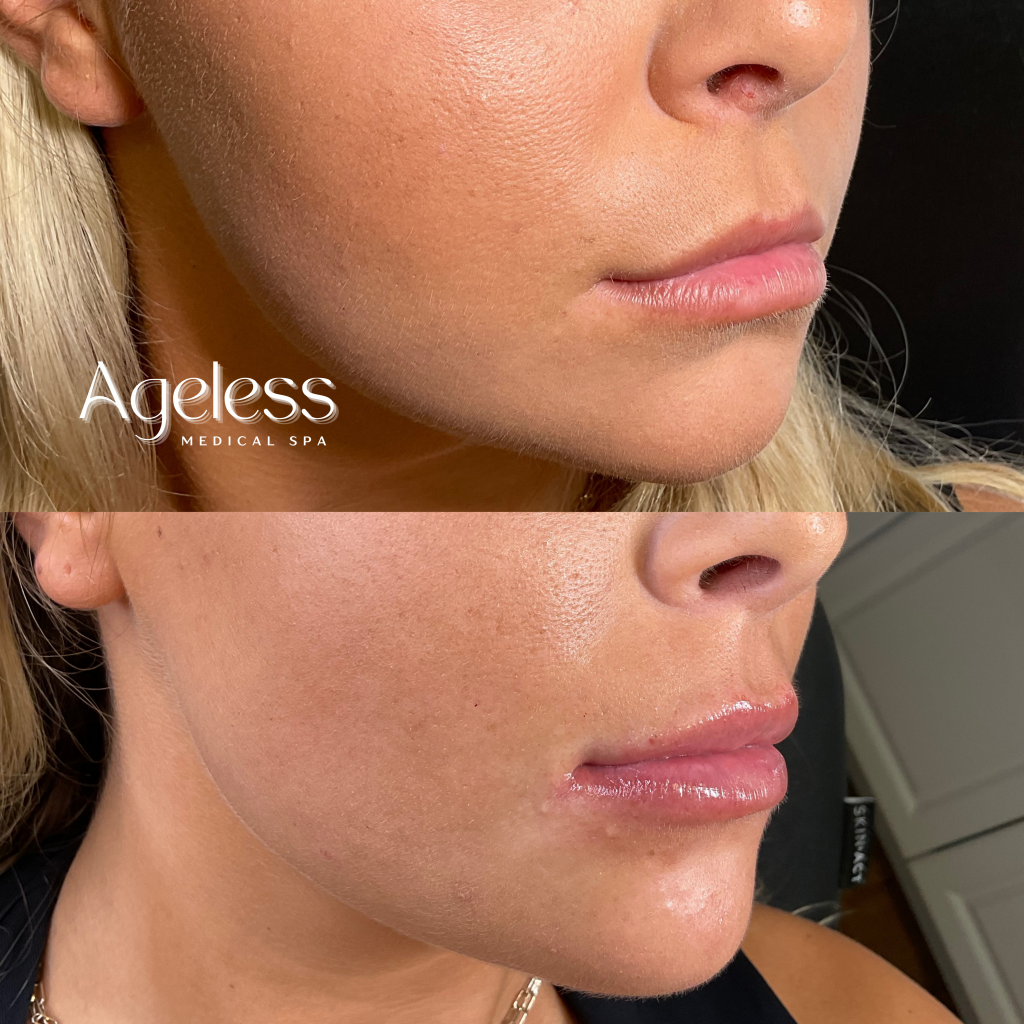 Lip Before & After Gallery - Ageless Medical Spa
