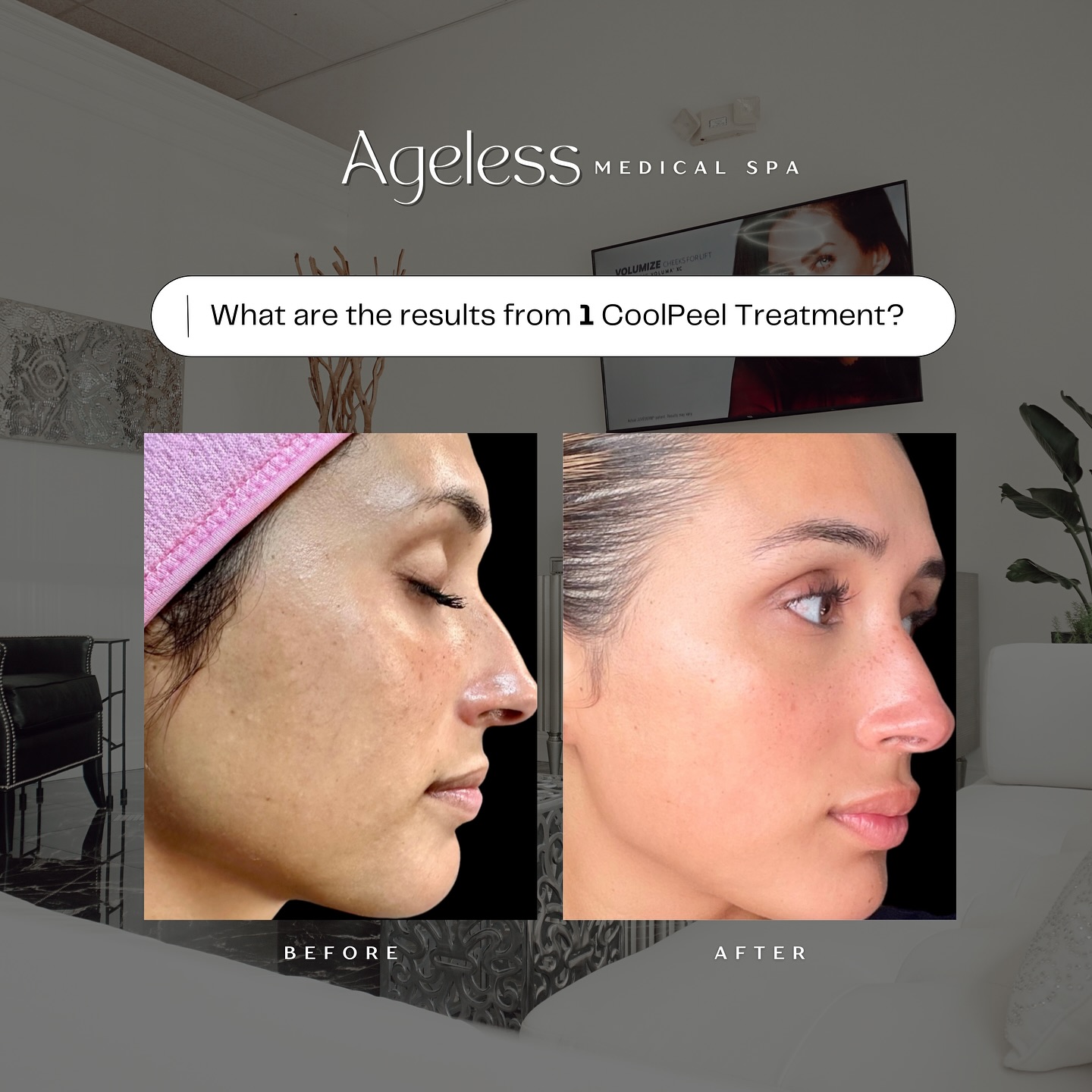 Attiva Before and After Gallery - Ageless Medical Spa