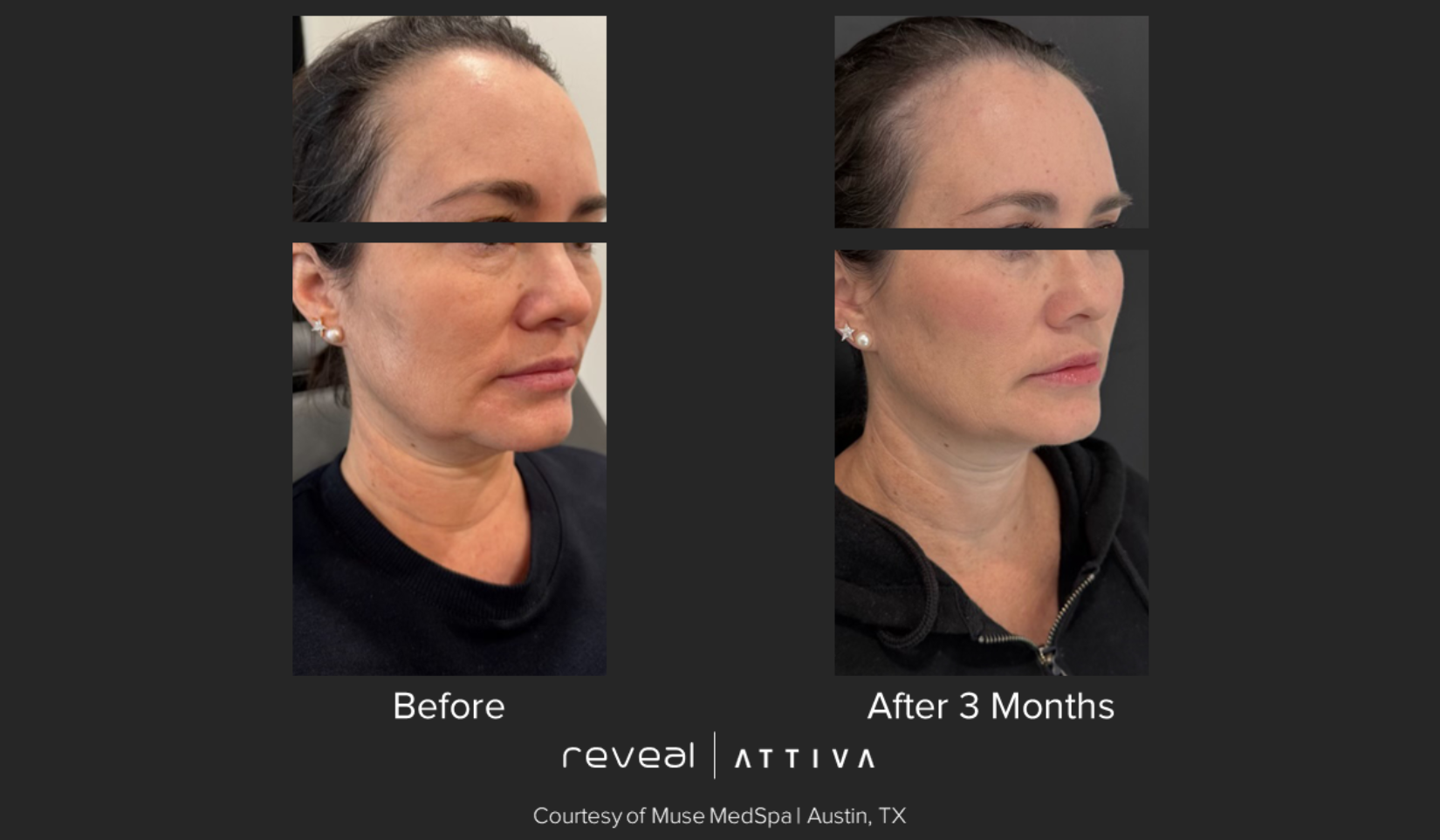 Attiva Before and After Gallery - Ageless Medical Spa