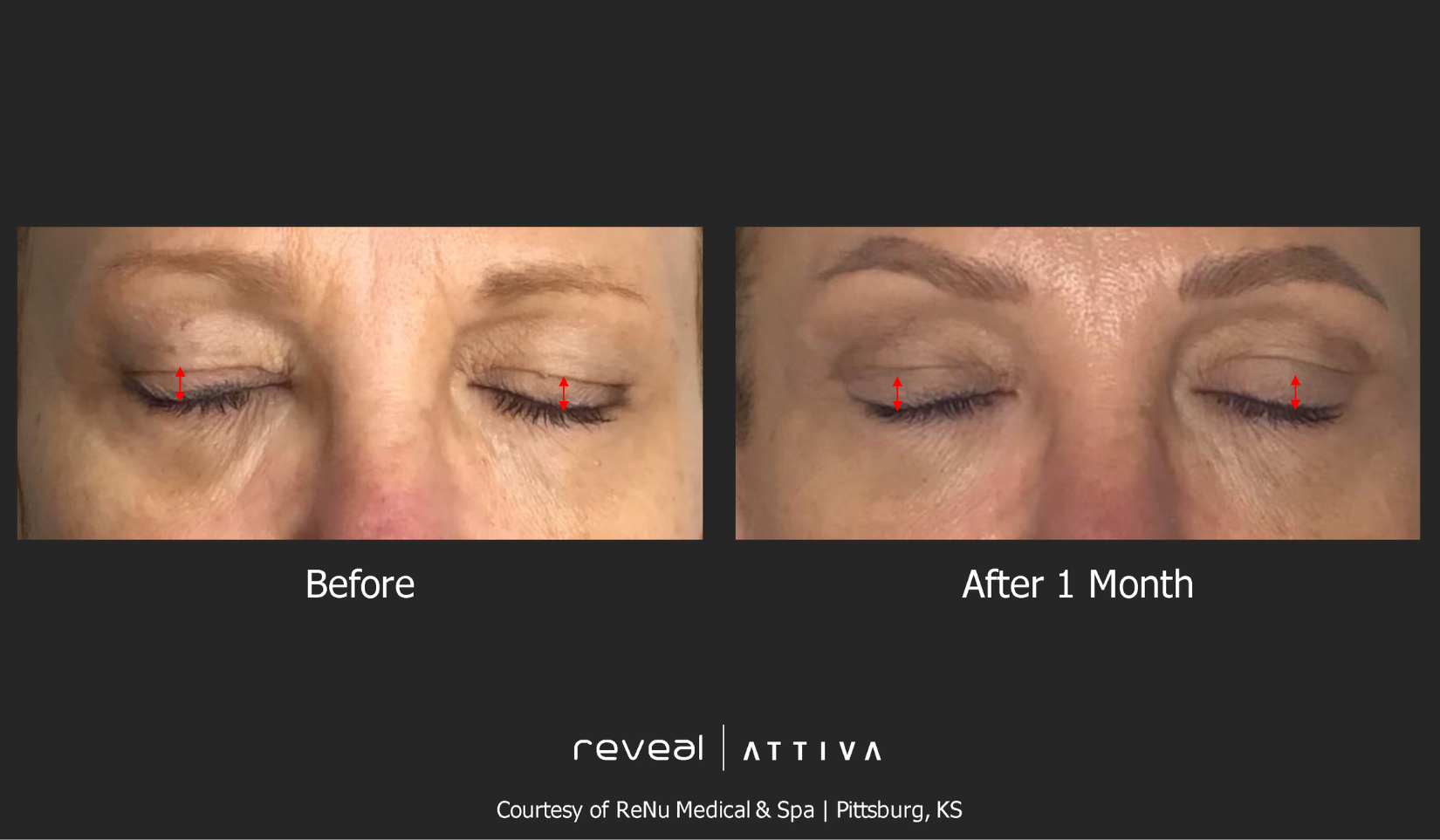 Attiva Before and After Gallery - Ageless Medical Spa