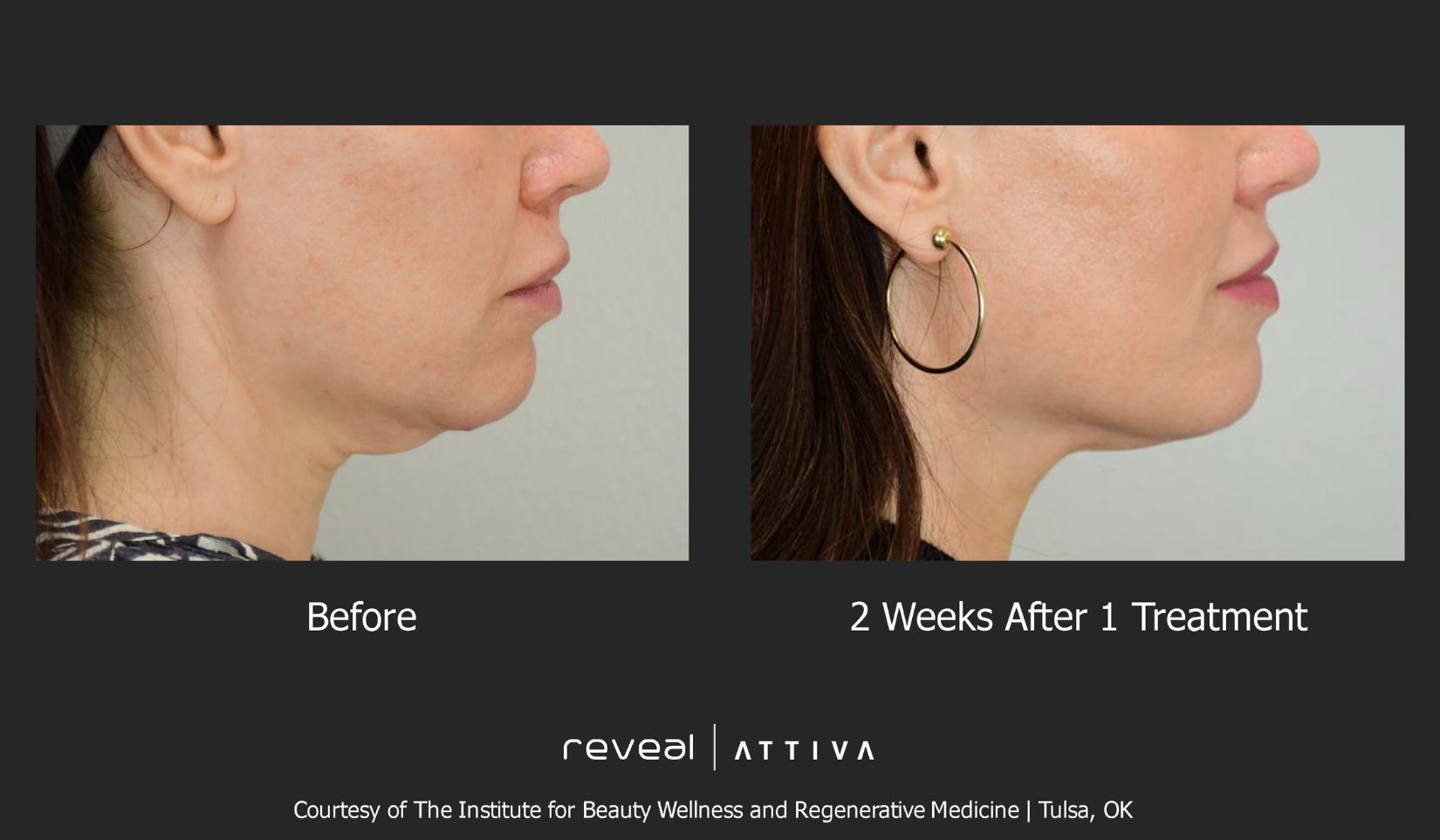 Attiva Before and After Gallery - Ageless Medical Spa