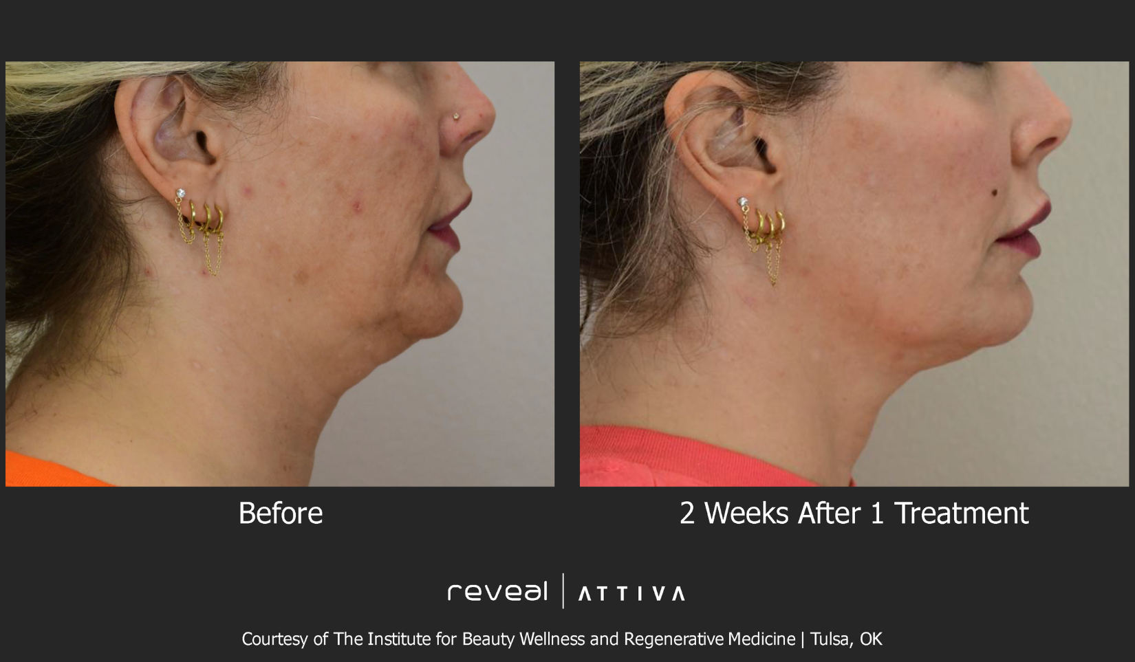 Attiva Before and After Gallery - Ageless Medical Spa