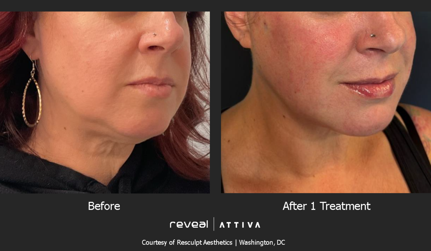 Attiva Before and After Gallery - Ageless Medical Spa